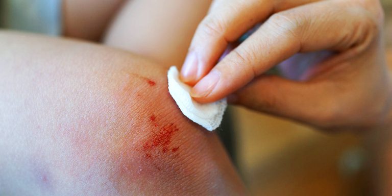 Cleaning Wounds: What is hydrogen peroxide used for? - The Ambulance ...